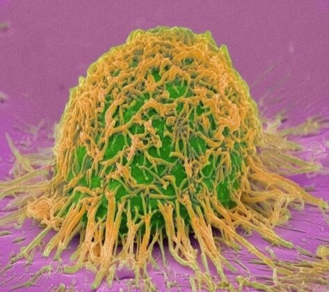 Does Cancer Have A Smell: Can cancer be detected by smell - thedoctorzones