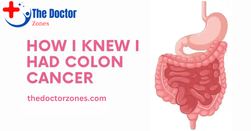 How I Knew I Had Colon Cancer: Symptoms of colon cancer - Thedoctorzones